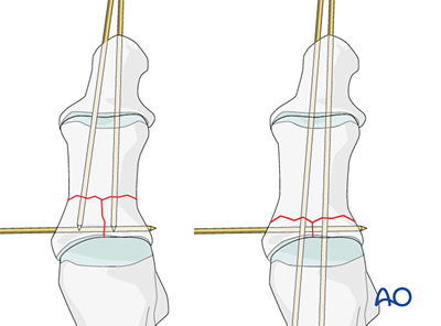 ORIF - K-wires for Complete articular fractures of the proximal hallux