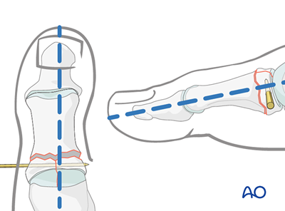 ORIF - K-wires for Complete articular fractures of the proximal hallux
