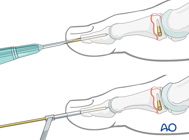 ORIF - K-wires for Complete articular fractures of the proximal hallux
