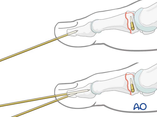 ORIF - K-wires for Complete articular fractures of the proximal hallux