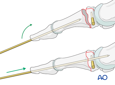 ORIF - K-wires for Complete articular fractures of the proximal hallux