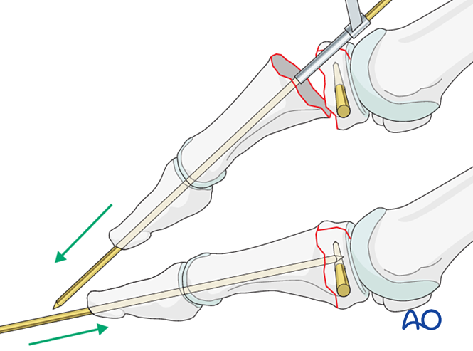 ORIF - K-wires for Complete articular fractures of the proximal hallux