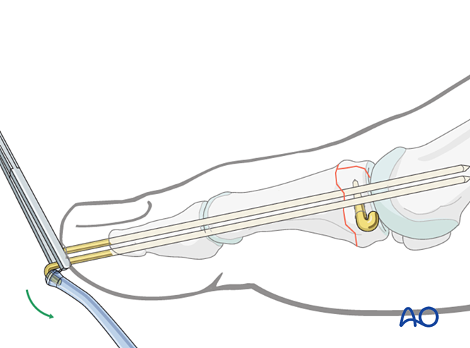 ORIF - K-wires for Complete articular fractures of the proximal hallux