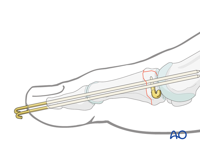 ORIF - K-wires for Complete articular fractures of the proximal hallux