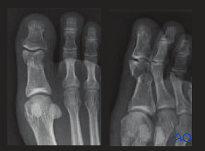 ORIF - K-wires for Complete articular fractures of the proximal hallux