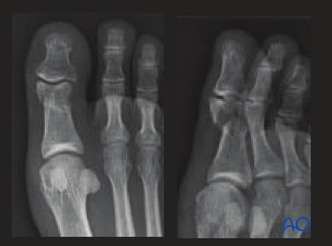 ORIF - K-wires for Complete articular fractures of the proximal hallux