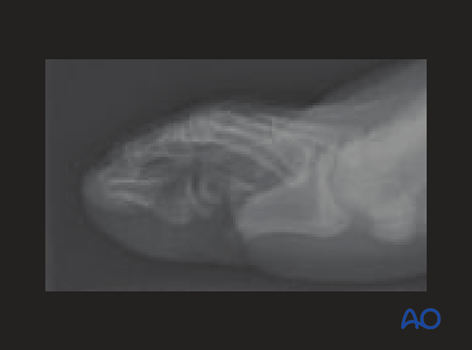 ORIF - K-wires for Complete articular fractures of the proximal hallux