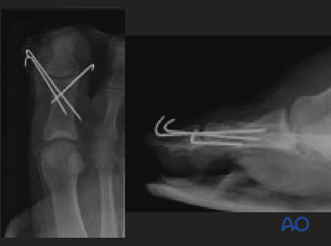ORIF - K-wires for Complete articular fractures of the proximal hallux