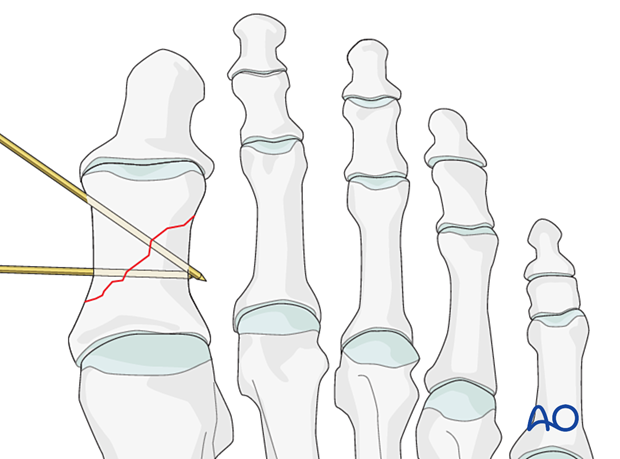 K Wire Fixation For Diaphyseal And Extraarticular End Segment Fractures