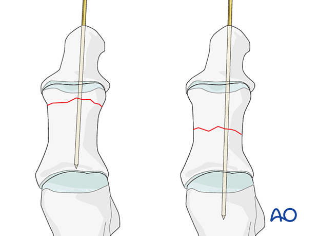 K Wire Fixation For Diaphyseal And Extraarticular End Segment Fractures