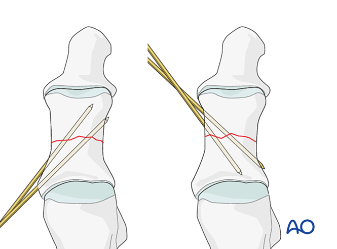 K Wire Fixation For Diaphyseal And Extraarticular End Segment Fractures