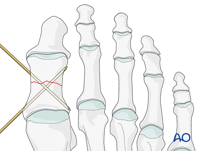 K-wire fixation for Diaphyseal and extraarticular end segment fractures ...