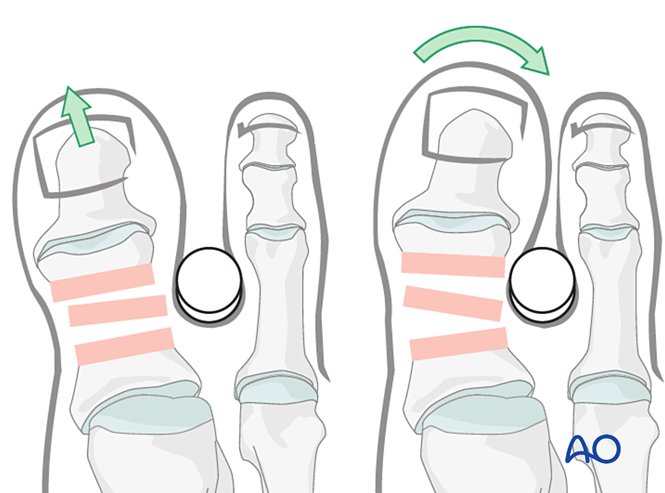 K Wire Fixation For Diaphyseal And Extraarticular End Segment Fractures
