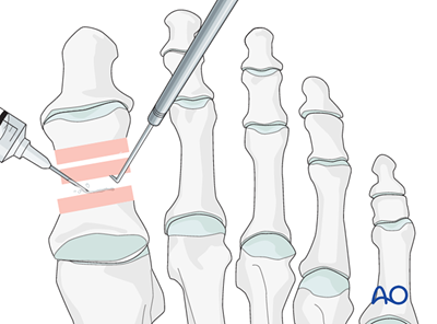 K-wire fixation for Diaphyseal and extraarticular end segment fractures ...