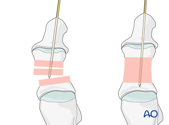 K-wire fixation for Diaphyseal and extraarticular end segment fractures ...