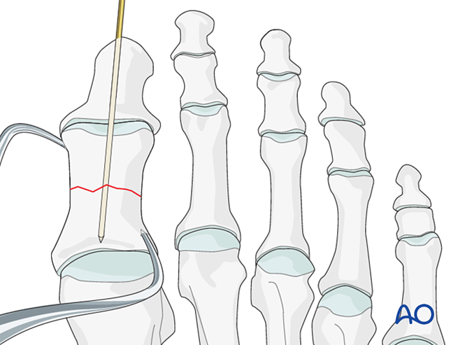 K-wire fixation for Diaphyseal and extraarticular end segment fractures ...