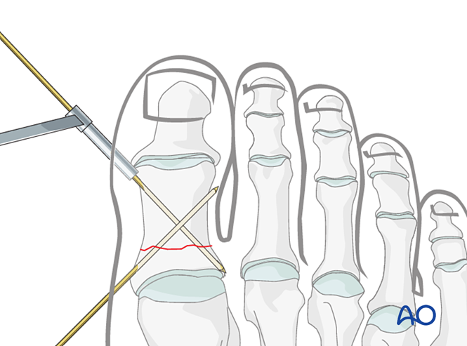 K Wire Fixation For Diaphyseal And Extraarticular End Segment Fractures
