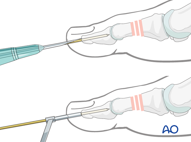 K-wire fixation for Diaphyseal and extraarticular end segment fractures ...