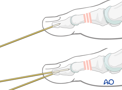K-wire fixation for Diaphyseal and extraarticular end segment fractures ...