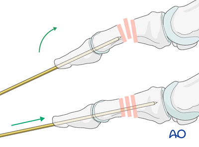 K-wire fixation for Diaphyseal and extraarticular end segment fractures ...