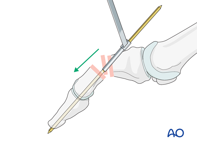 K-wire fixation for Diaphyseal and extraarticular end segment fractures ...