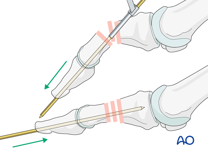 K-wire fixation for Diaphyseal and extraarticular end segment fractures ...