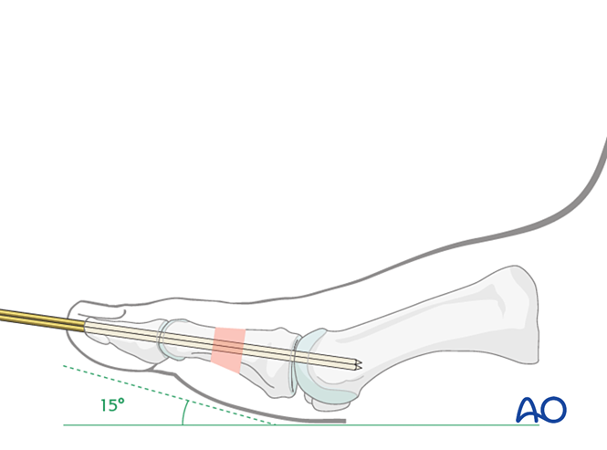 K Wire Fixation For Diaphyseal And Extraarticular End Segment Fractures