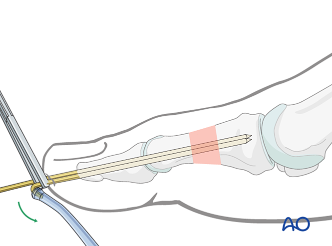 K-wire fixation for Diaphyseal and extraarticular end segment fractures ...