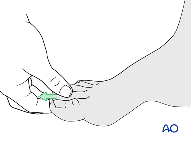 K Wire Fixation For Distal Extraarticular Fractures Of The 1st To 4th