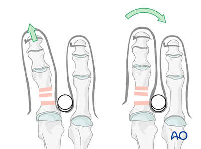 K-wire fixation for Lesser toe fractures