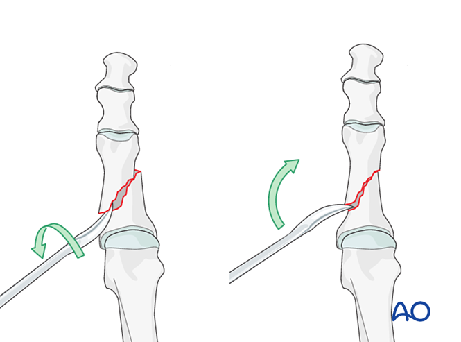K-wire fixation for Lesser toe fractures
