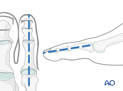 K-wire fixation for Lesser toe fractures
