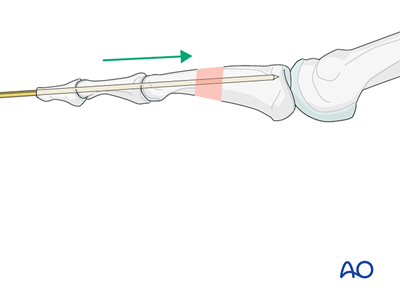K-wire fixation for Lesser toe fractures