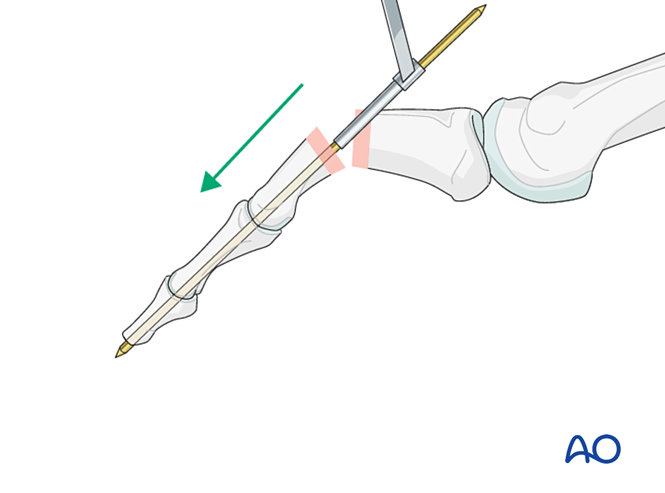 K-wire fixation for Lesser toe fractures