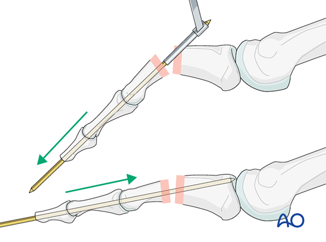K-wire fixation for Lesser toe fractures