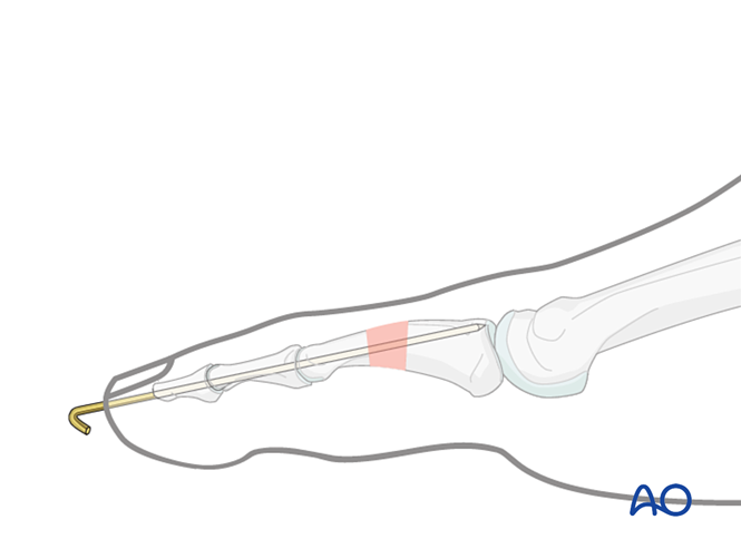 K-wire fixation for Lesser toe fractures
