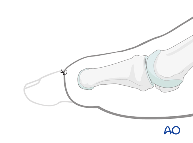 Amputation for Distal hallux fractures