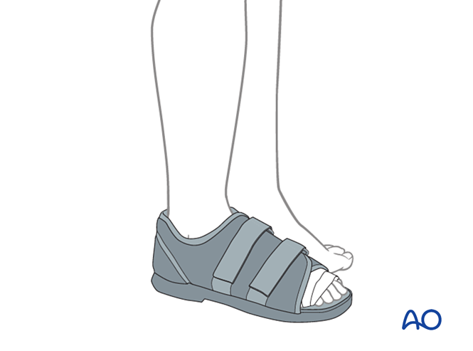 Amputation for Distal hallux fractures