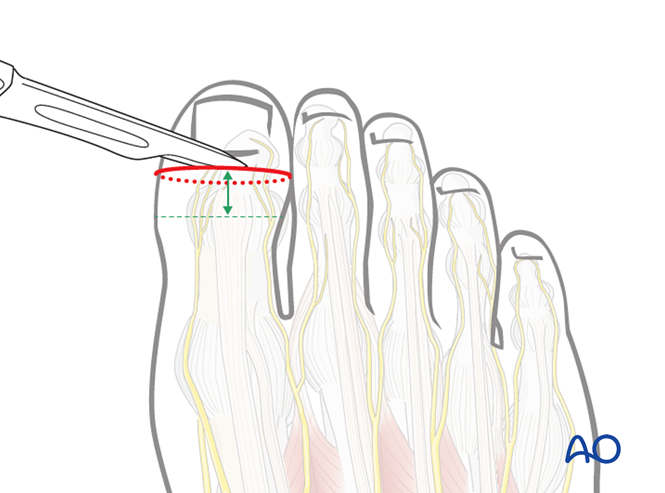 Amputation for Distal hallux fractures