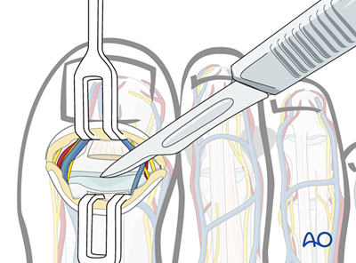 Amputation for Distal hallux fractures