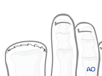 Amputation for Distal hallux fractures