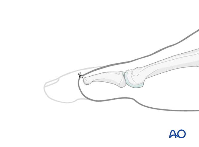 Amputation for Lesser toe fractures