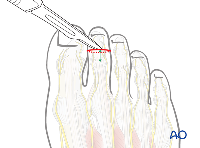 Amputation for Lesser toe fractures