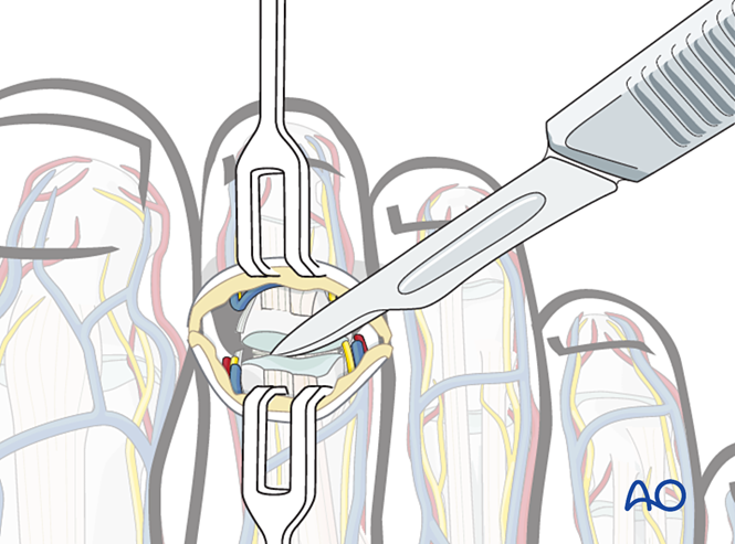 Amputation for Lesser toe fractures