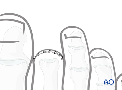 Amputation for Lesser toe fractures