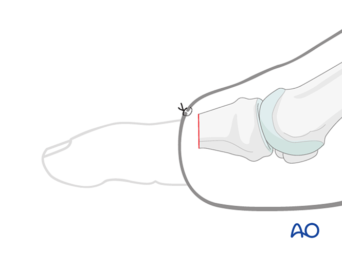 Amputation for Partial articular fractures of the proximal hallux