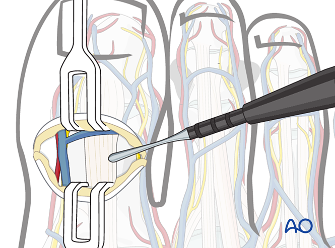 Amputation for Partial articular fractures of the proximal hallux