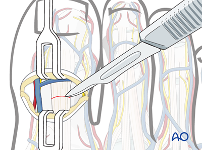 Amputation for Partial articular fractures of the proximal hallux