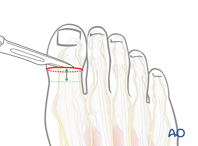 Amputation for Partial articular fractures of the proximal hallux