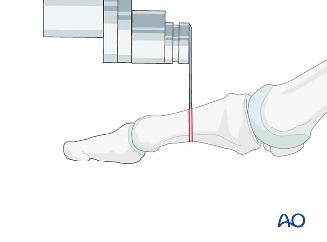 Amputation for Partial articular fractures of the proximal hallux